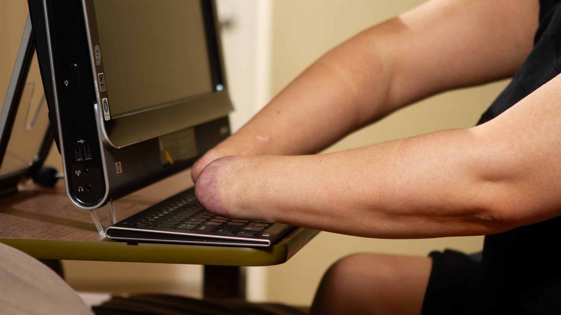 Amputation Levels | Arm Dynamics